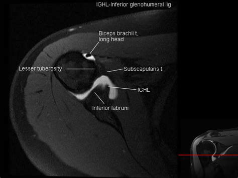 Shoulder Arthrogram
