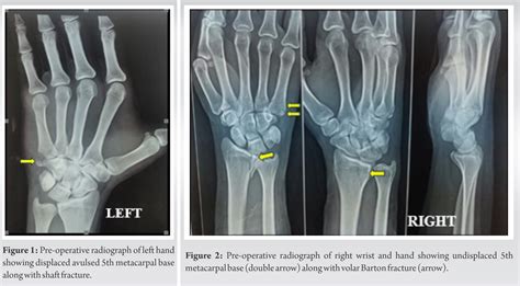 Bilateral Avulsion Fractures Of Extensor Carpi Ulnaris A Case Report Journal Of Orthopaedic