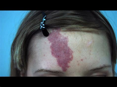 Родимые пятна на теле как удалять красные пигментные сосудистые невусы