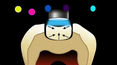 Composite Dental Polymerization At Steven Payton Blog