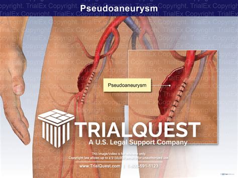 Pseudoaneurysm
