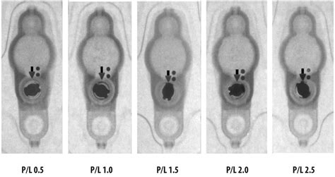 Ventricular Shunt Reference The Neurosurgical Atlas
