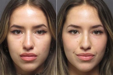 Under Eye Filler Photos Hollywood Ca Patient 1228