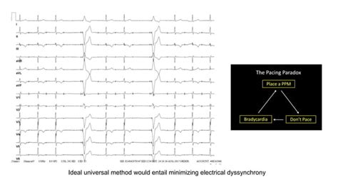 Review Of Conduction System Pacing Pptx