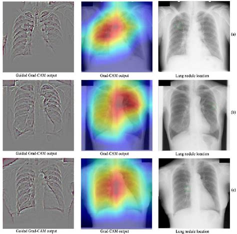 Figure 6 From Explainable Ai For Early Lung Cancer Detection A Path To Confidence Semantic