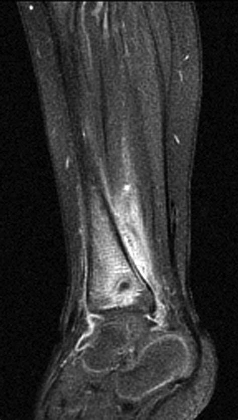 Type Of Mri For Osteomyelitis At Stacy Buxton Blog