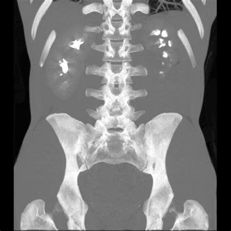 Duplicated Collecting System Pacs