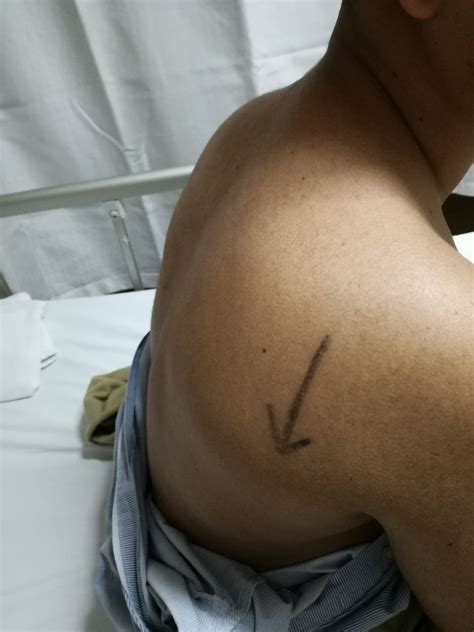 Giant Cell Tumour Of The Scapula Treated By Partial Scapulectomy Bmj Case Reports