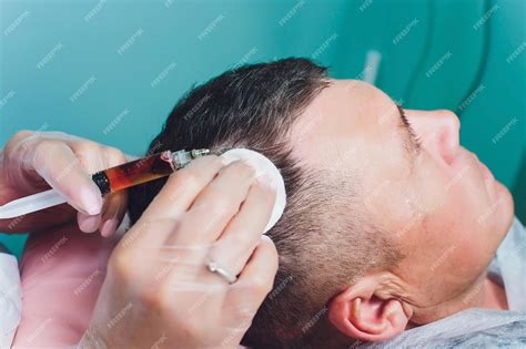 Premium Photo Treatment Of Baldness With Beauty Injections