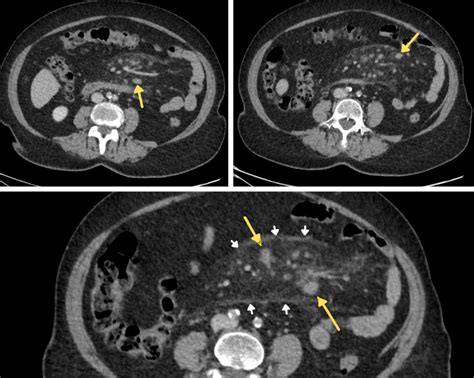 Mesenteric Panniculitis A Clinical Conundrum Pmc