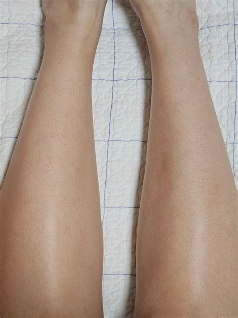 다리 레이저 제모 후 지식in