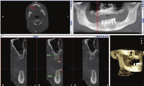 The Example Of Cbct Imaging Including Cross Sectional View Showing The