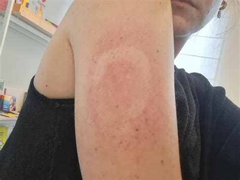 Skinissue Alergic Reaction Romnipod