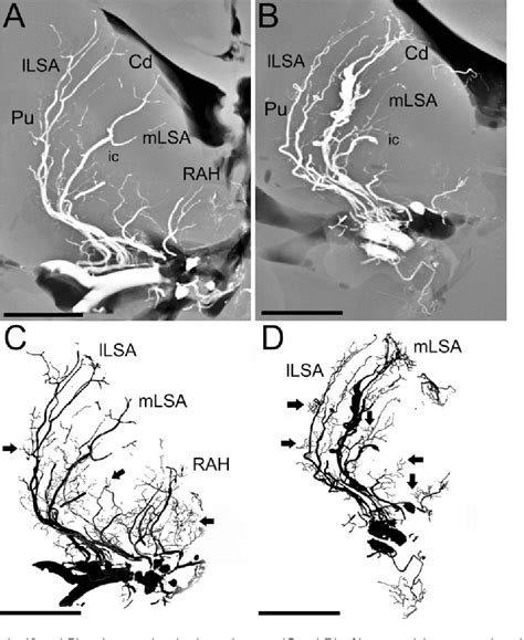 Distal Medial Striate Artery Semantic Scholar