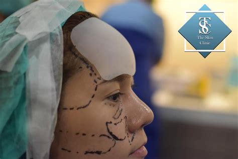 👸🤴รีวิวหน้าผากเม่ง โหนกนูน 🎉ด้วยการเสริมหน้าผาก ด้วยแผ่นซิลิโคน🎉 🎀ผลลัพธ์จากการเสริมซิลิโคน🎀