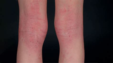Why Do I Have Eczema On My Legs