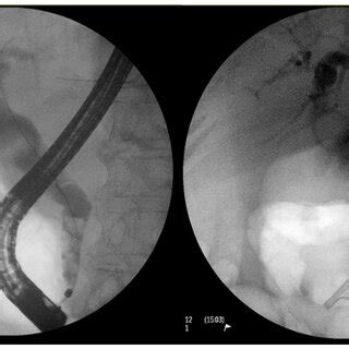 Left Cholangiogram Showing Multiple Filling Defects And Dilated Download Scientific Diagram
