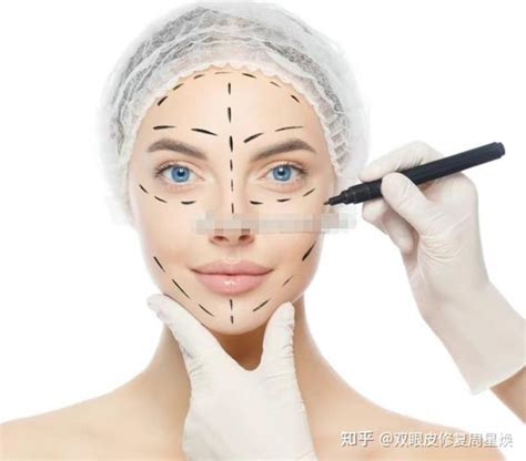 周星焕双眼皮修复 鼻基底和鼻子的关系是怎么样子 知乎