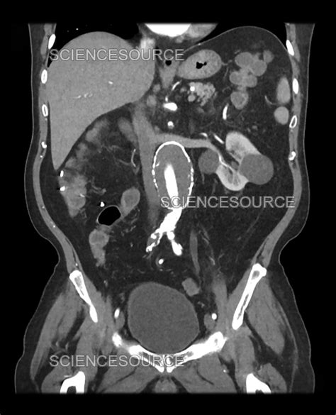 Cta Of Abdominal Aortic Aneurysm Stock Image Science Source Images