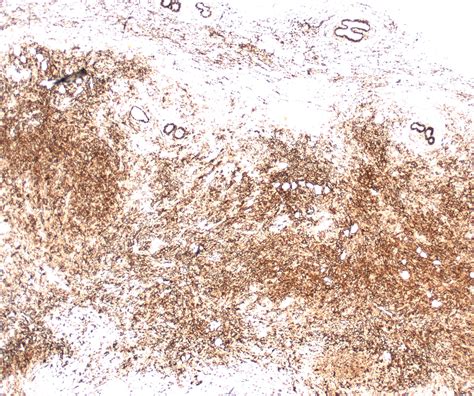 Primary Breast Sarcoma A Rare And Challenging Diagnostic Entity Diagnostic Histopathology