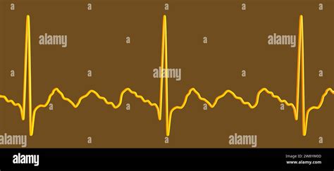 Atrial Flutter Abnormal Heartbeat Rhythm Illustration Stock Photo Alamy