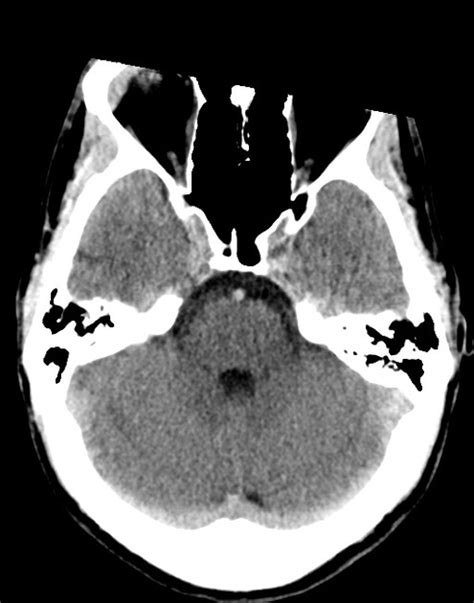 Differential Diagnosis Of Headache