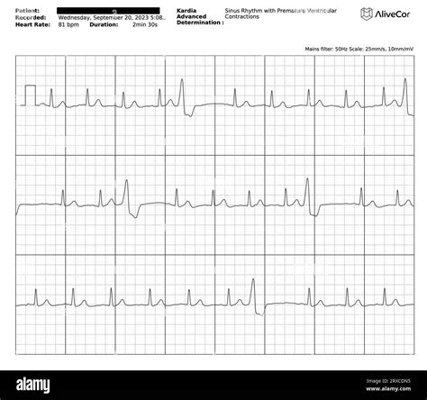 Ecg Ekg Graph Plot Chart Trace Showing Some Premature