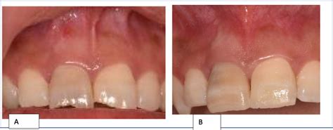 Revascularization Of A Tooth With Necrotic Pulp And Ap Ccide