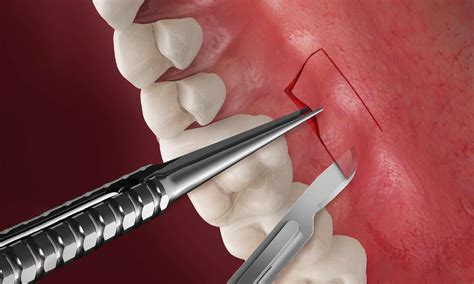 Soft Tissue Graft The Dental Group At Central City In Surrey Bc