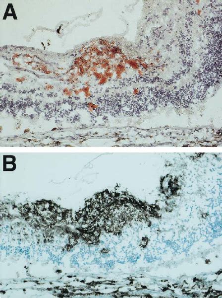 Case 2 9 Months Later There Is Regression Of Retinal Hard Exudate Download Scientific Diagram