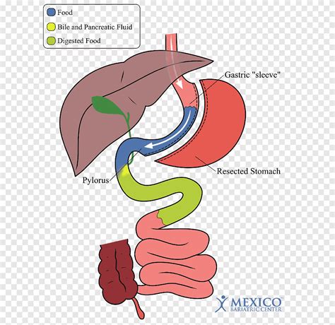 Kindke39s Scrap Notes Duodenal Bypass Resolves Type 2