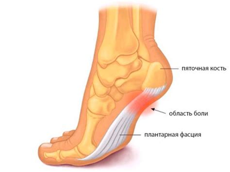 Плантарный фасциит — симптомы и лечение