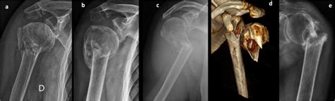 Surgical Neck Sn Fracture A Minimally Displaced Sn Fracture With