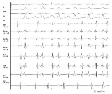 Following A Sinus Beat Spontaneous Atrial Ectopy From The Ligament Of