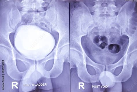 X Ray Film Of Rgu And Mcu Retrograde Urethrogram And Micturating