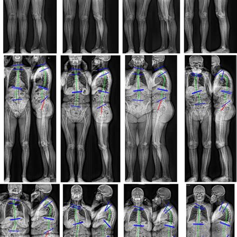 The Four Types Of The Roussouly Sagittal Classification The Shape Of