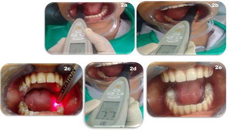 Clinical Procedure Fig 2a Laser Fluorescence Preoperative Value Of 21 Download Scientific