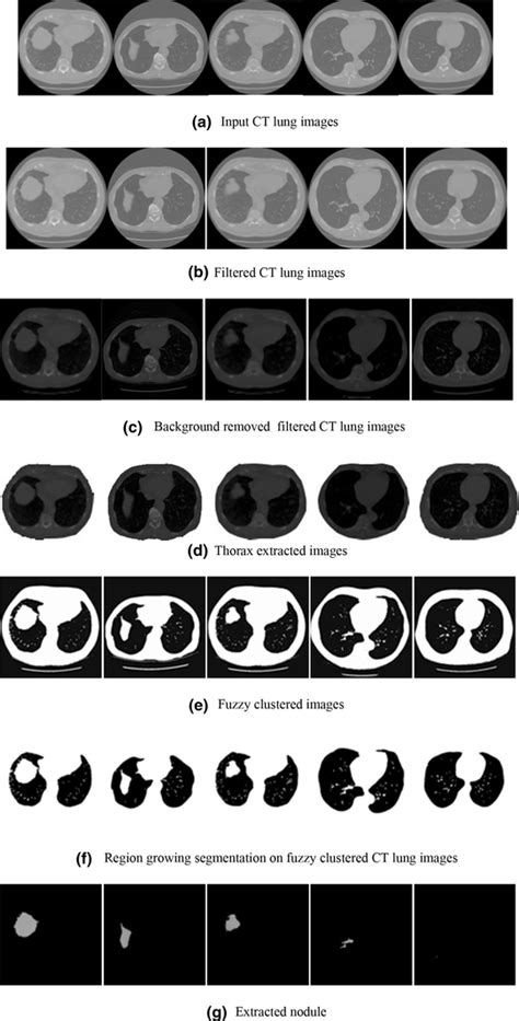 The Proposed Optimal Lung Nodules Detection Sequences Download Scientific Diagram