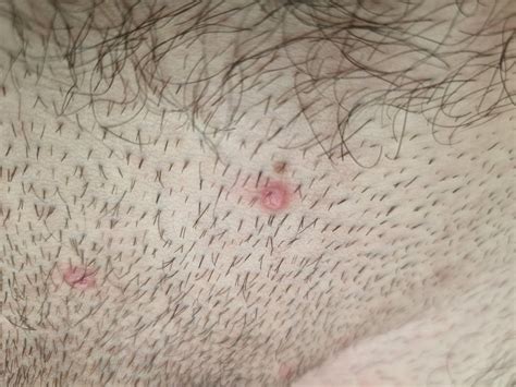 Red Pimples In Genital Area Rdermatologyquestions