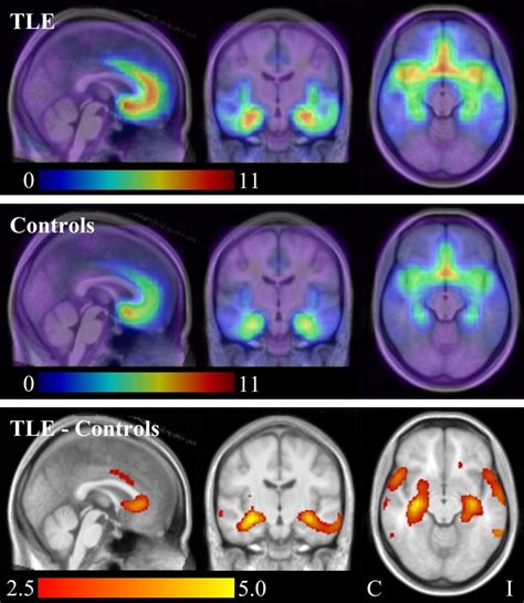 Temporal Lobe Epilepsy In Patients With Nonlesional Mri The Role Of