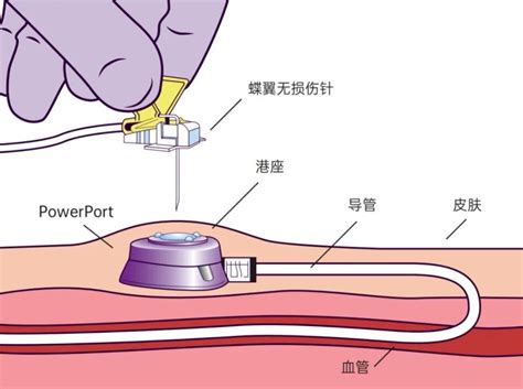 无微不治 超声引导下输液港植入让患者找到温暖港西海岸新区中心医院凤凰网青岛 凤凰网