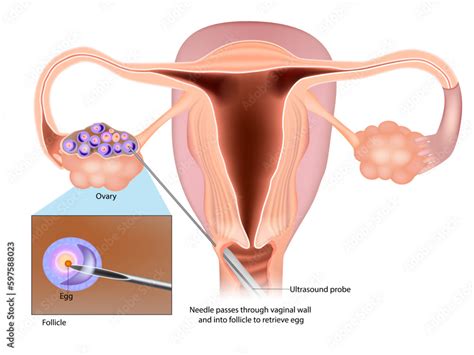 Ivf Egg Retrieval Technique Egg Retrieval Procedure Before In Vitro Fertilization Stock Vector