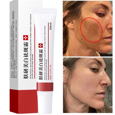 3pcs цикл Крем для лица отбеливающий для удаления веснушек пигментных пятен мелазмы шрамов от