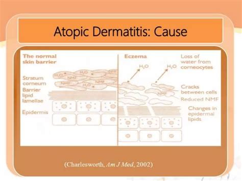 Atopic Dermatitis Immunology Pptx