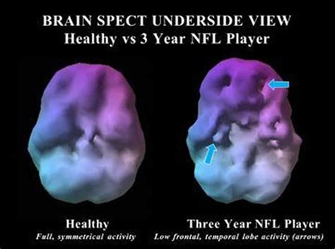 Abnormally Low Blood Flow Indicates Brain Damage In Nfl Players
