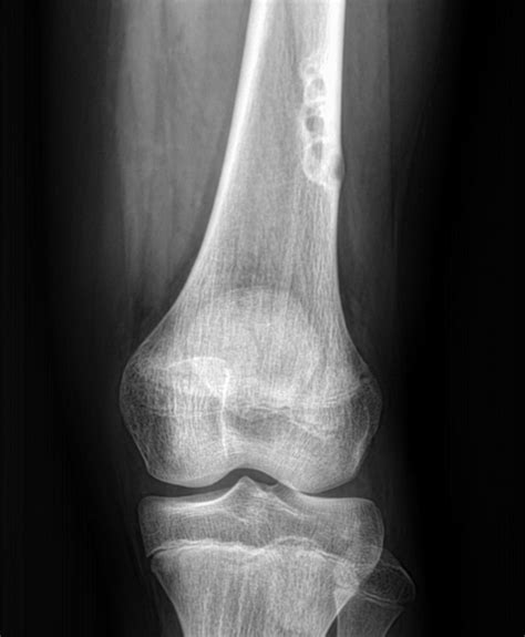 Ossifying Fibroma Femur Management Of Paediatric Benign Bone Tumour