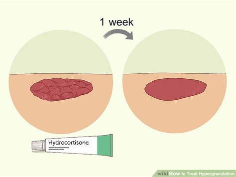 8 Ways To Treat Hypergranulation Wikihow Health
