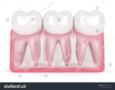 Vertical Root Fracture Over 5 Royalty Free Licensable Stock Illustrations And Drawings Shutterstock