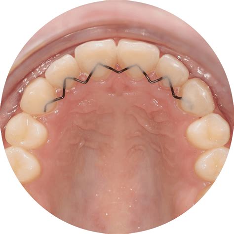 Orthodontics Permanent Retainer At Tyler Mckinley Blog