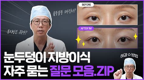눈두덩이 지방이식 👀 꺼진 눈 피곤한 눈 살리는 눈두덩이 지방이식에 대해 많았던 질문들 모아모아 명확하게 답변해드려요 📢 Youtube